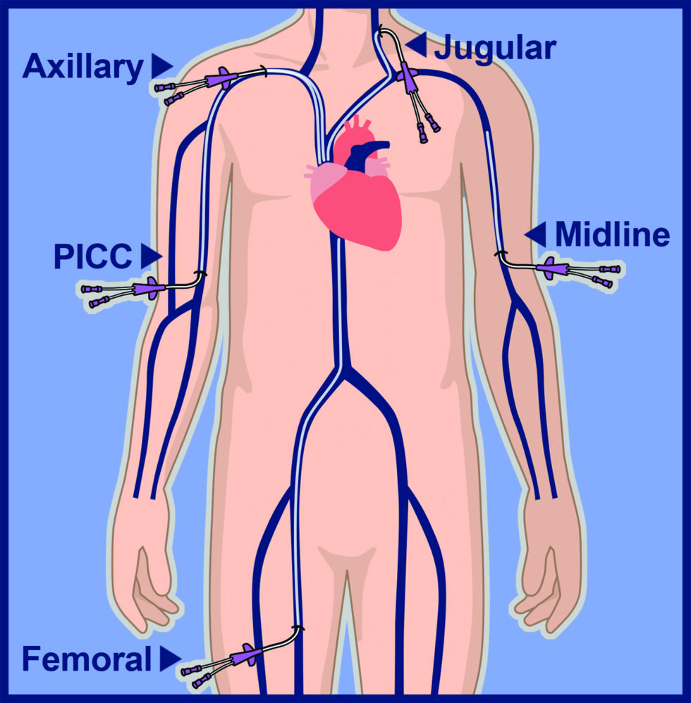 Central Venous Catheter Lines Vascular Wellness Central Venous Catheter Lines Vascular Wellness