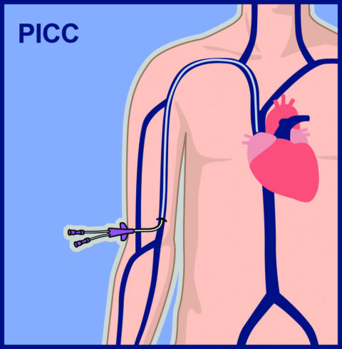 PICC Lines | Vascular Wellness