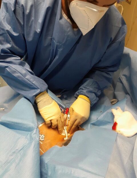 Vas Cath for Dialysis | Vascular Wellness