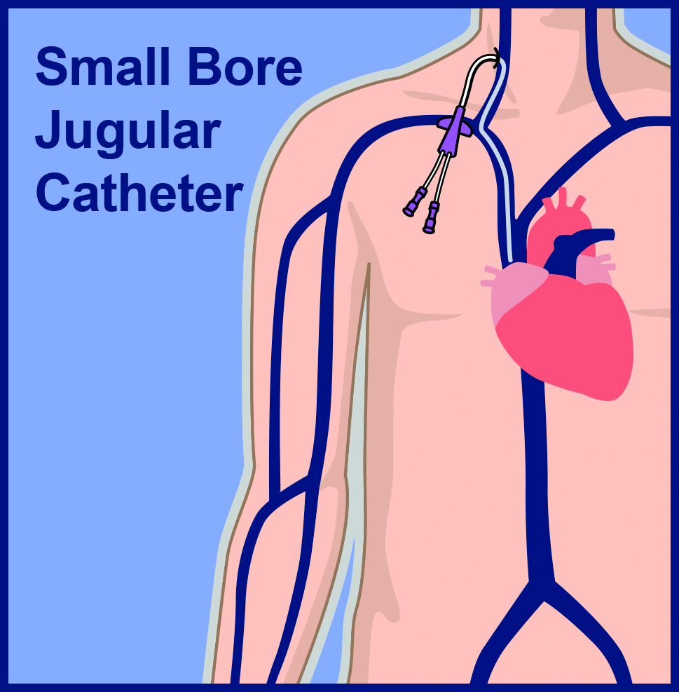 Mastectomy And Vascular Access Vascular Wellness Mastectomy And Vascular Access Vascular Wellness