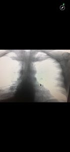 Pinch-Off Syndrome - Nurse Clinicians in Action-01 | Vascular Wellness