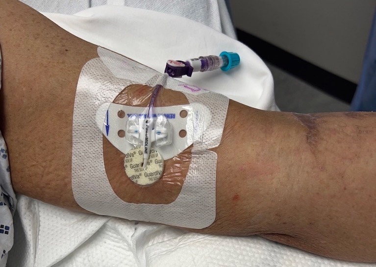 Central Venous Catheter | Vascular Wellness