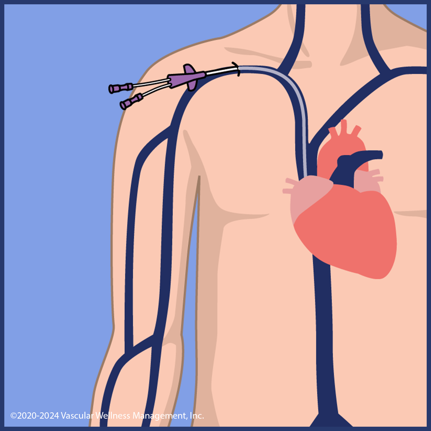 Vascular Access Patient Education | Vascular Wellness