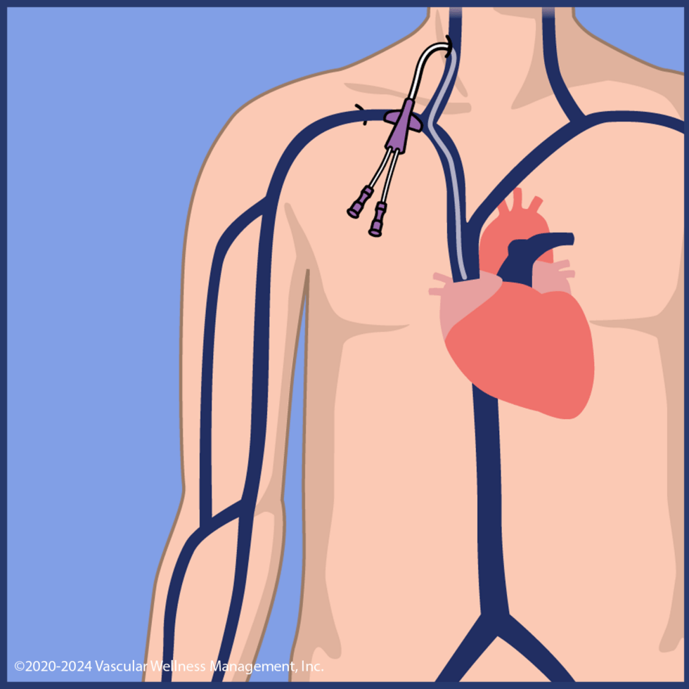 Vascular Access Patient Education | Vascular Wellness