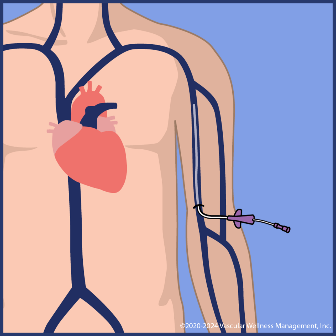 Vascular Access Patient Education | Vascular Wellness