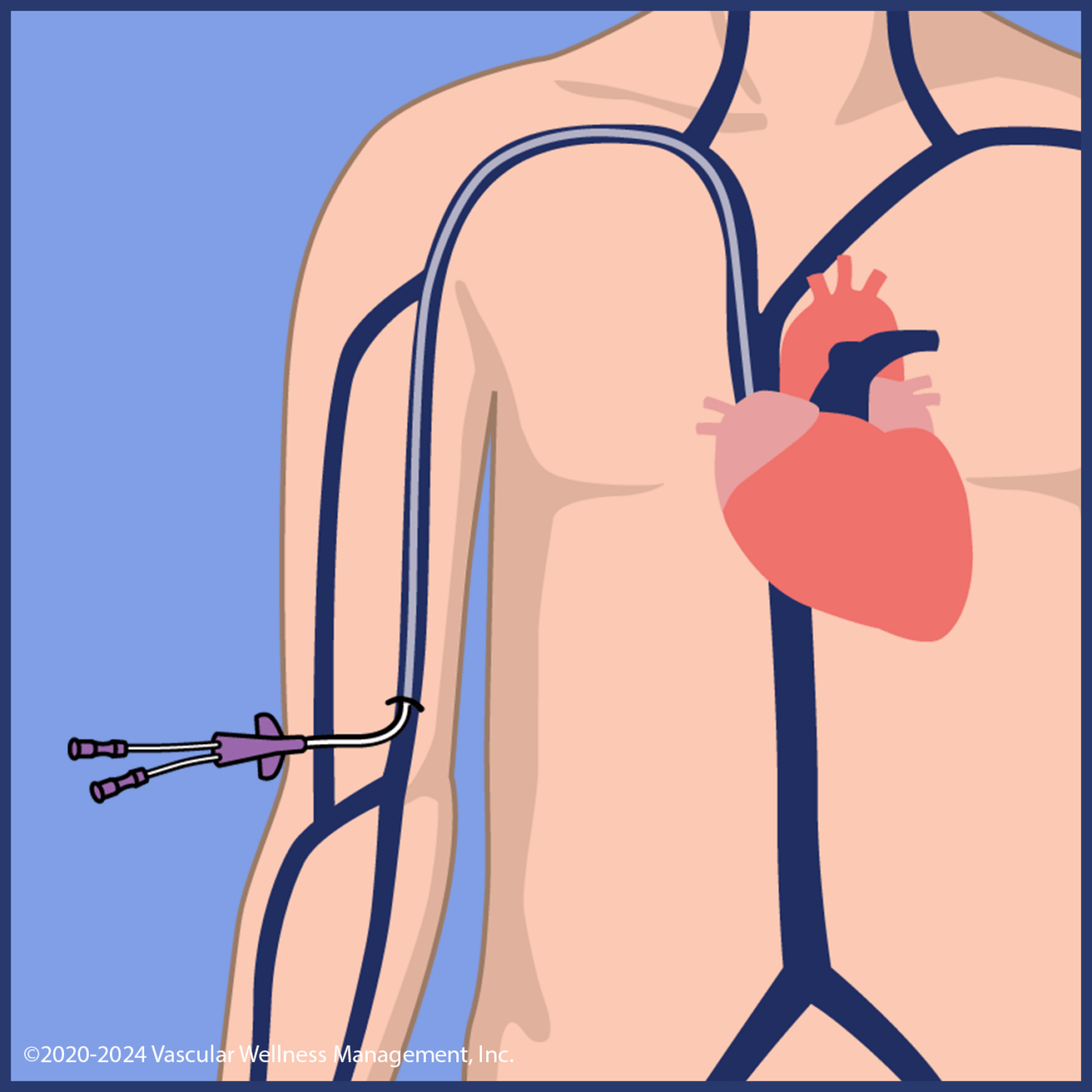 Vascular Access Patient Education | Vascular Wellness