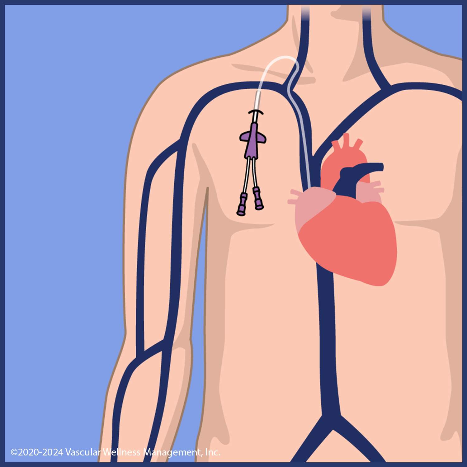 Vascular Access Patient Education | Vascular Wellness