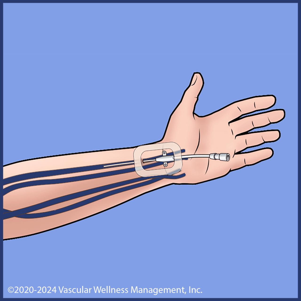 Vascular Access Patient Education | Vascular Wellness