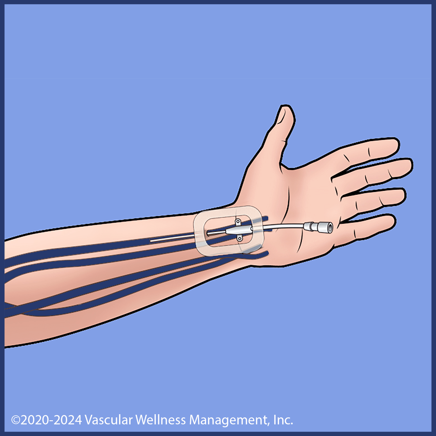 Vascular Access Patient Education | Vascular Wellness