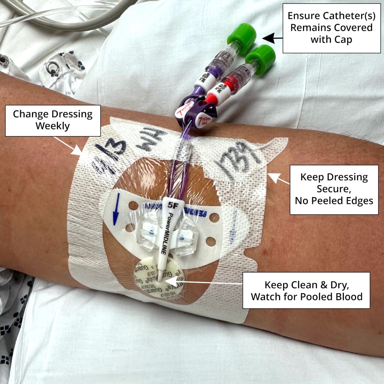 Vascular Access Patient Education | Vascular Wellness