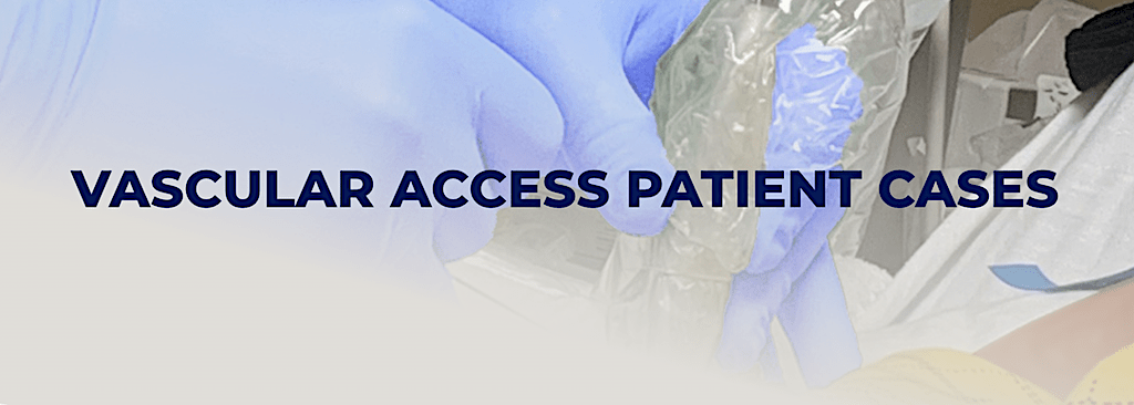 IV Infiltration and Extravasation Causes and Prevention | Vascular Wellness