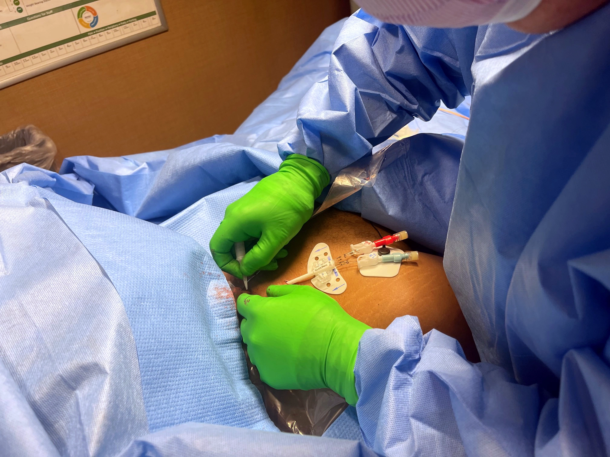 Vascath Exchanged to Tunneled Permcath | Vascular Wellness